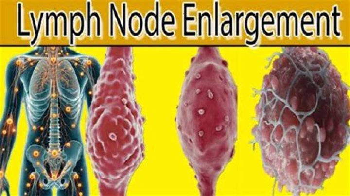 What size is considered an enlarged lymph node? - TruthNet News